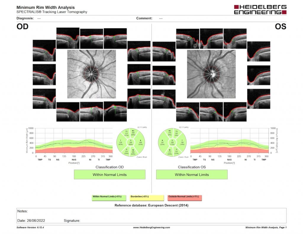 Glaucoma Examination Brisbane Optometrist – Dean Samarkovski Optometrist Brisbane